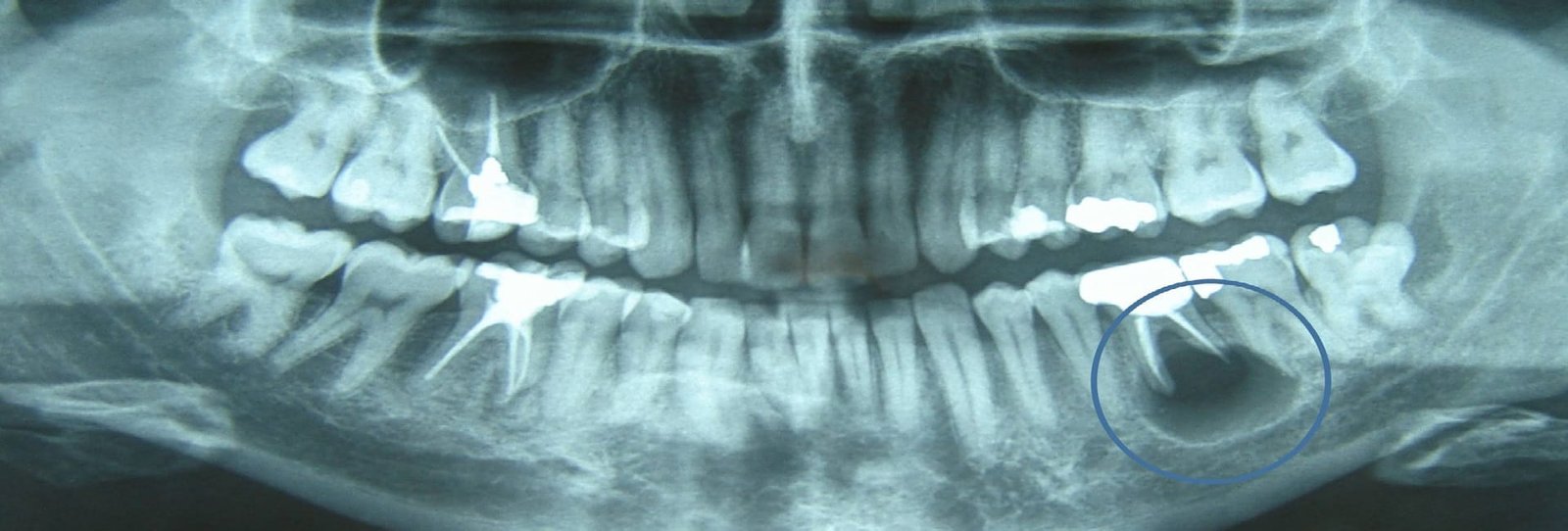 Understanding Radicular Cyst: Symptoms, Causes, and Treatment - Denta ...