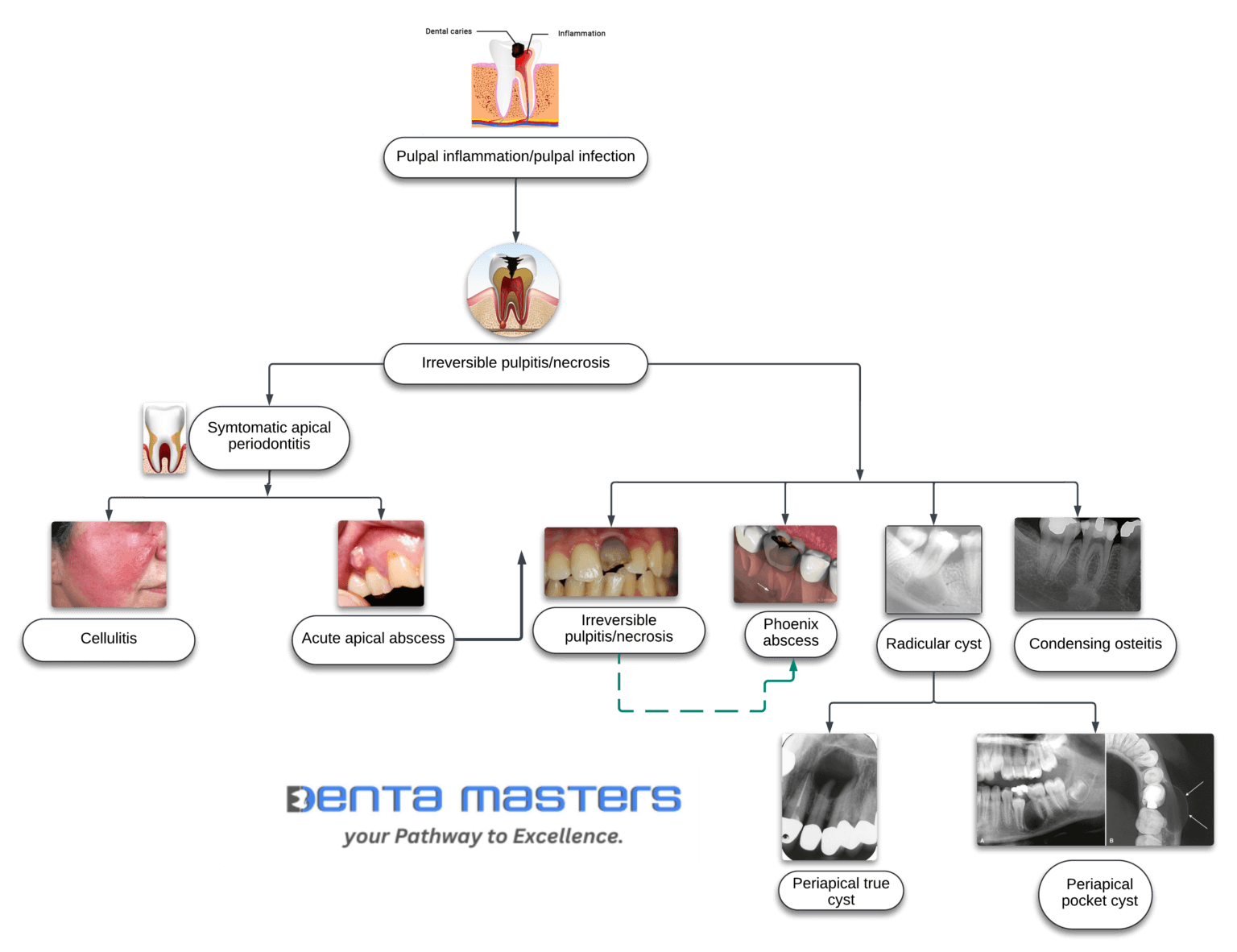 alveolar abscess: Cause, symptoms, diagnosis & treatment - Denta Master