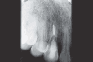 External Root Resorption - DentaMasters