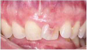 Replacement Resorption Tooth - DentaMasters