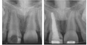 Mineral Trioxide Aggregate - DentaMasters