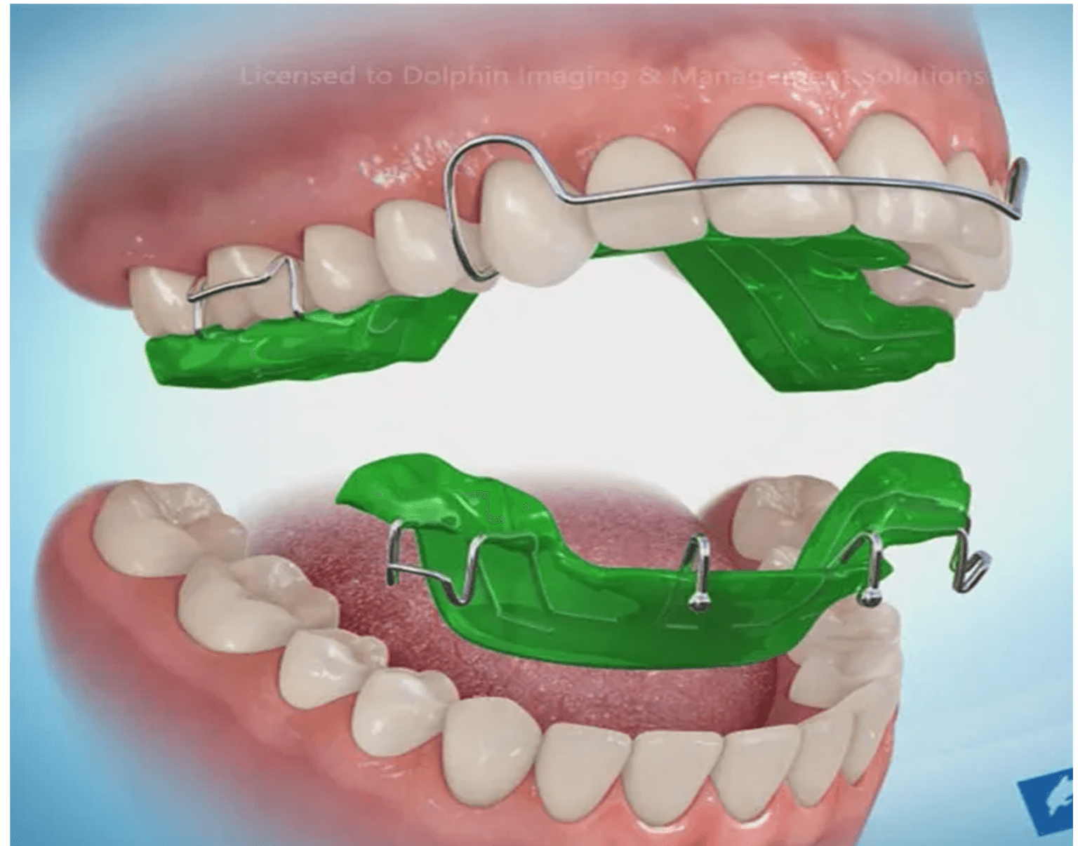 Malocclusion (Misaligned Teeth): Treatment, management & Risk
