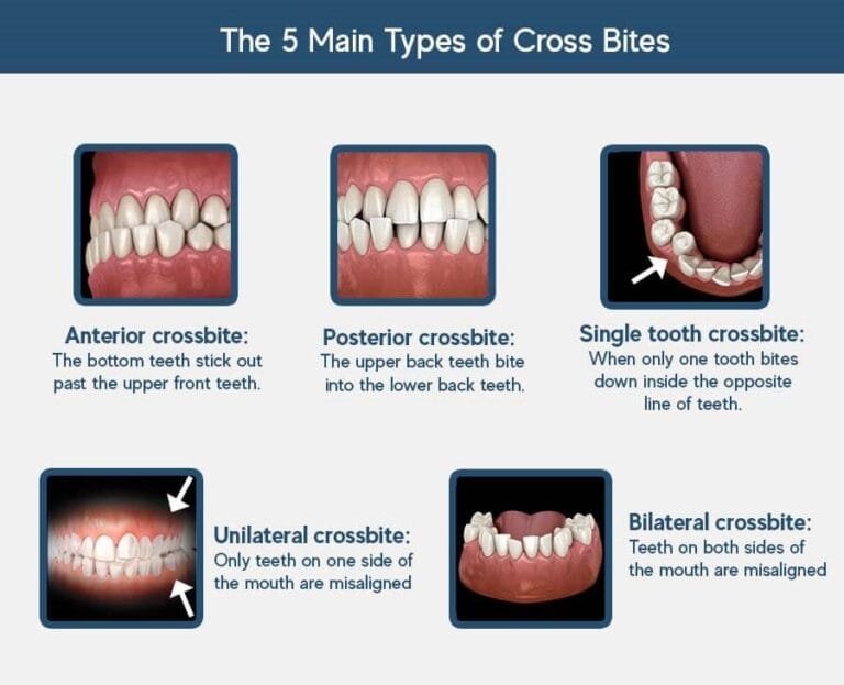Malocclusion (Misaligned Teeth): Angle's classifications - DentaMasters