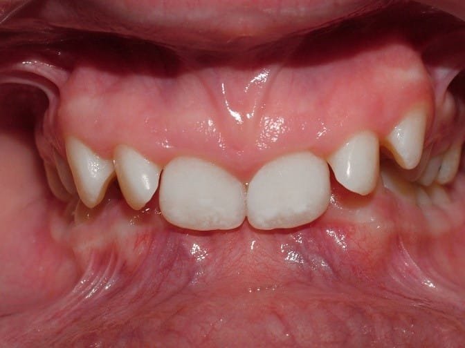 Malocclusion (Misaligned Teeth): Angle's classifications - DentaMasters