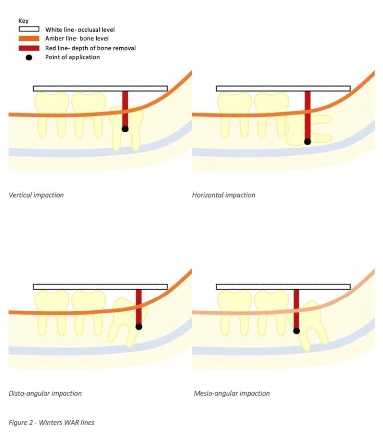 Wisdom Tooth: Classification and Complications - DentaMasters