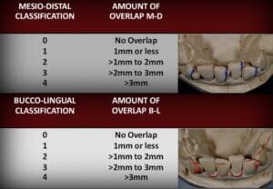 Malocclusion (Misaligned Teeth): Angle's classifications - DentaMasters