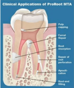 Mineral Trioxide Aggregate - DentaMasters