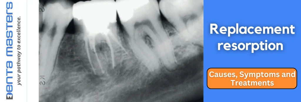 External Root Resorption - DentaMasters